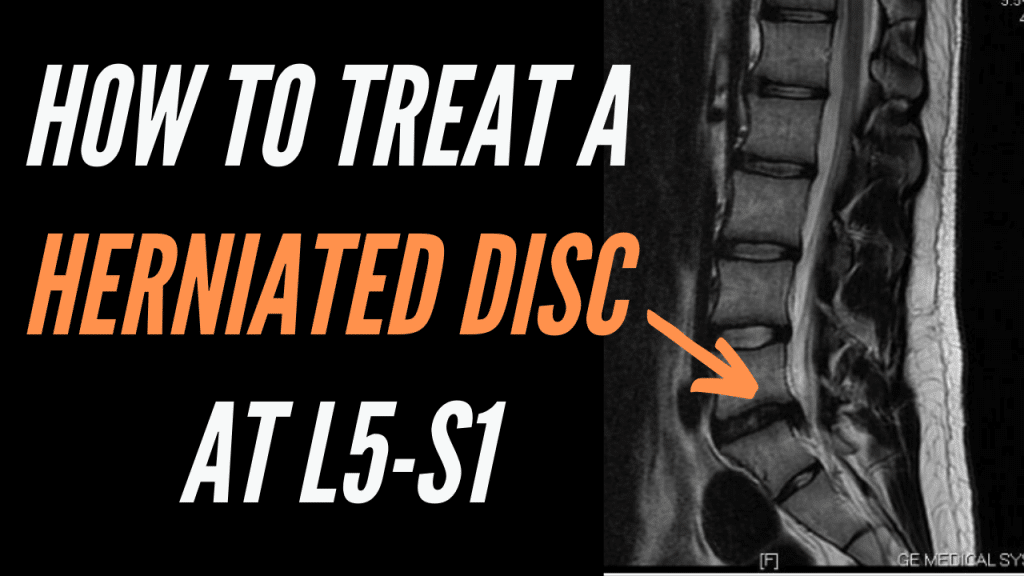 How A Herniated Disc At L5-S1 Is Treated