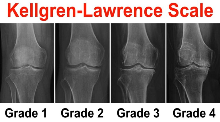 What Can You Do for Bone on Bone Knee Pain Relief?