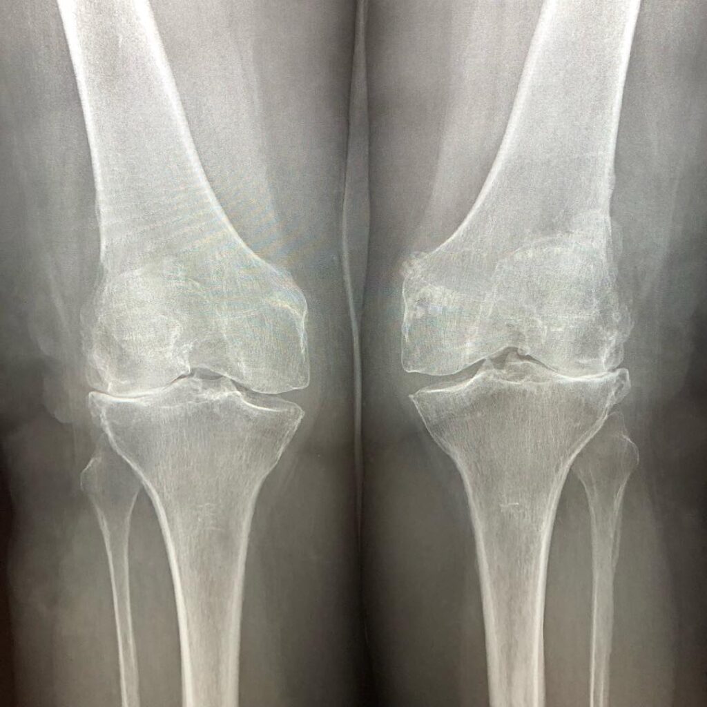 Bowlegged or Knock-Knee Arthritis? Do This to Walk Without Pain