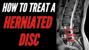 How To Treat A Herniated Disc At L4-L5 or L5-S1